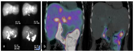 Simple And Contrasted Thoracoabdominal Ct Cholangiolar Abscesses