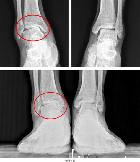 발목인대손상발목관절