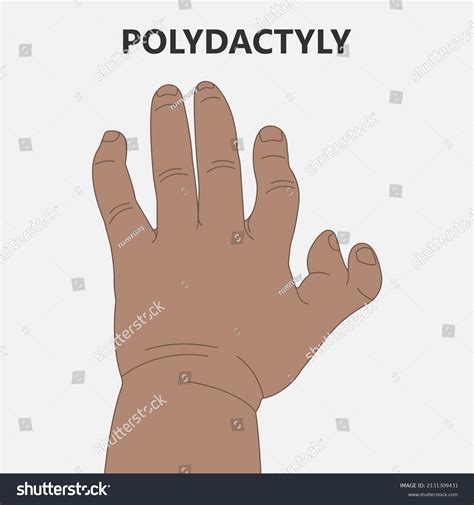 Hand Finger Gene Prader Willi Band Stock Vector Royalty Free 2131309431 Shutterstock