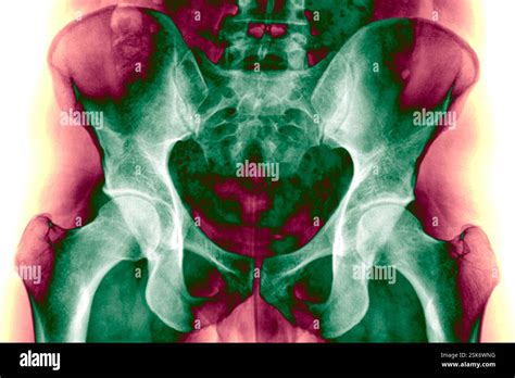 Coloured X Ray Front View Of The Healthy Bones Of The Pelvis In A 34