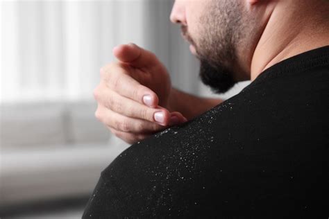 What Are The Signs And Symptoms Of Dandruff