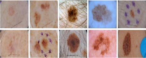 [논문 리뷰] tesl net a transformer enhanced cnn for accurate skin lesion
