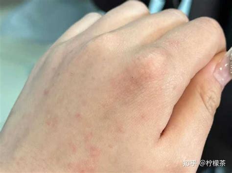 湿疹皮炎会传染吗？一般会出现在什么部位？ 知乎