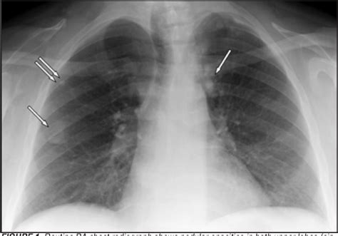Figure 1 From Metastatic Pulmonary Calcification Semantic Scholar
