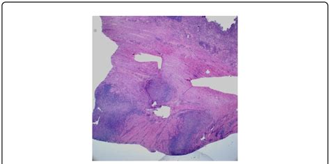 Histology From Surgical Specimen Showing Inflammation And Abscess