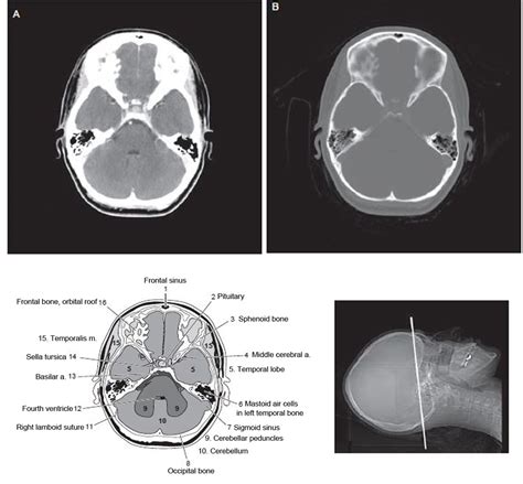 Head Ct Scan Procedure Radtechonduty Ct Scan Brain Anatomy Ct My Xxx