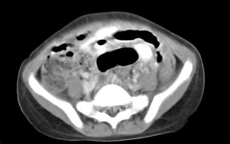 Radiopaedia Case Perforated Appendix Id 14081 Study 13927 Nc Commons