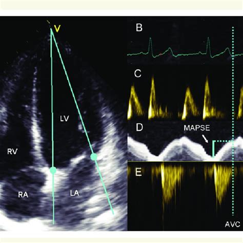 Examples Of Normal And Reduced Septal Mitral Annular Plane Systolic Download Scientific Diagram