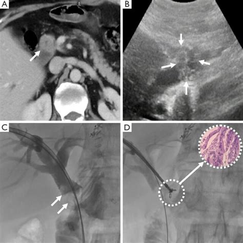 A 56 Year Old Male At 1 Year After Cholangiocarcinoma Resection The Download Scientific