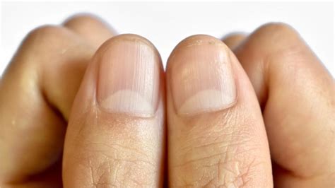 Discover What Those Nail Dents Reveal About Your Health The Nail