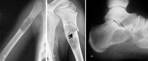 Simple Bone Cyst Fallen Fragment Sign