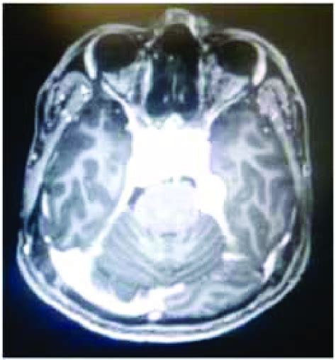 Mri Done In Year 2014 Imaging Shows Nodular Thickening And Enhancement Download Scientific