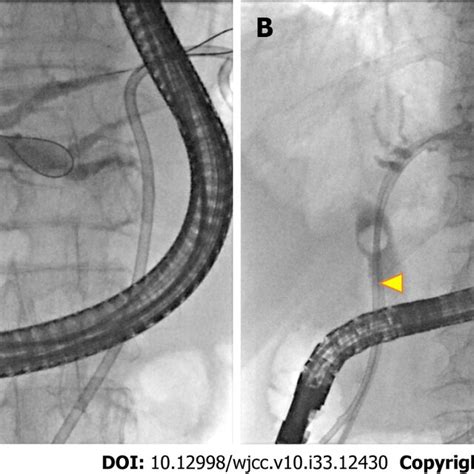 Endoscopic Retrograde Cholangiopancreatography A Dilated Common Bile Download Scientific