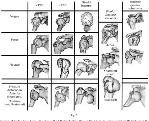 figure 2 from a three dimensional classification for fractures of the proximal humerus