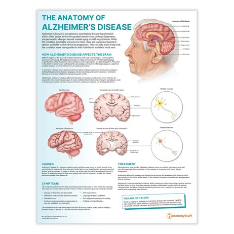 The Anatomy Of Alzheimers Disease Chartposter Laminated Anatomystuff