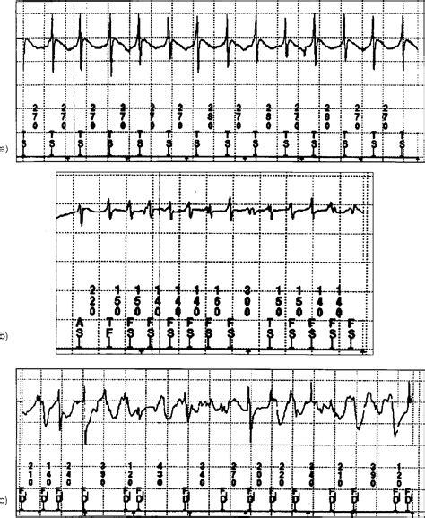 Table 1 From Prevalence Characteristics And Clinical Implications Of Regular Atrial