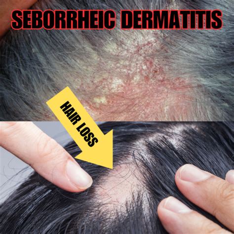 News Can Seborrheic Dermatitis Cause Hair Loss