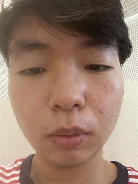 5 Month Progress Rtretinoin