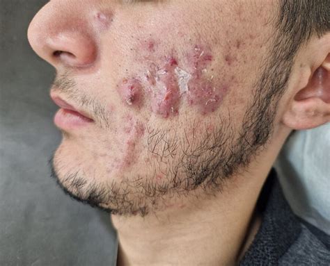 Acne Grau 4 Nodular Grave Acne Conglobata Algoritmd