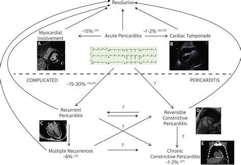 Myocarditis Pericarditis Electrocardiogram Ekg Wave Diffuse St Acute