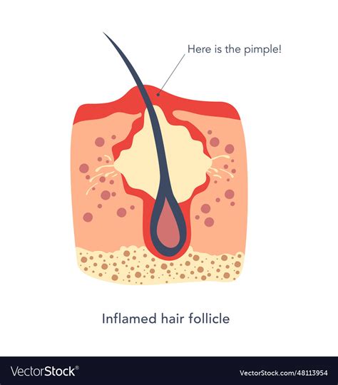 Inflamed Hair Follicle Medical Scheme Zoomed Vector Image