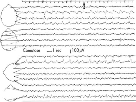 Encephalopathy With Eeg Based Grading Ppt