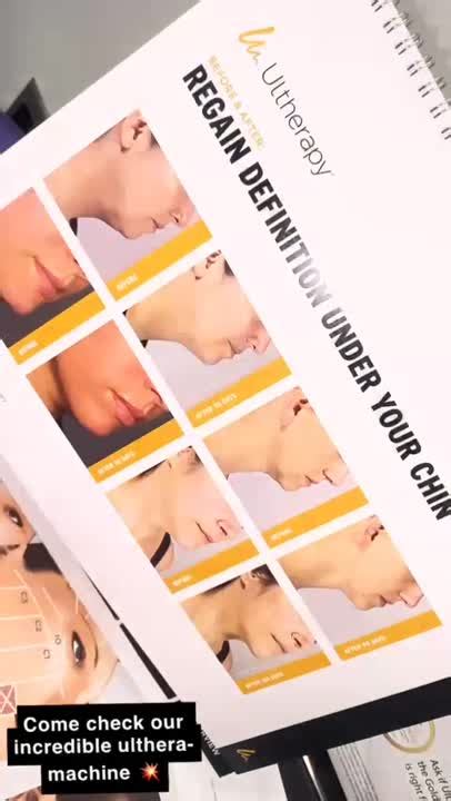 Gheed Al Qaysi On Linkedin Ultherapy Skintightening