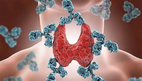 Хронический аутоиммунный тиреоидит причины симптомы диагностика лечение