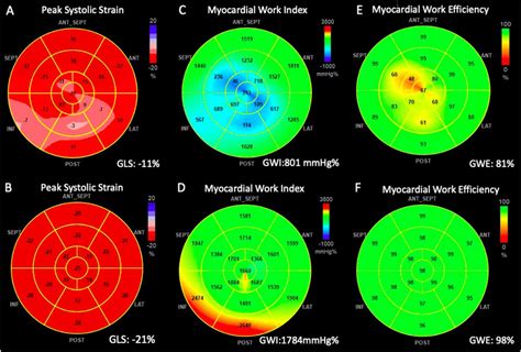 Seventeen Segment Bulls Eye Representation Of Longitudinal Strain A Download Scientific