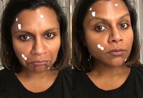 Why Are We Obsessed With Popping Pimples And How To Stop Tweak India