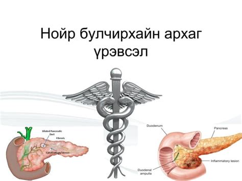 Нойр булчирхайн архаг үрэвсэл Ppt