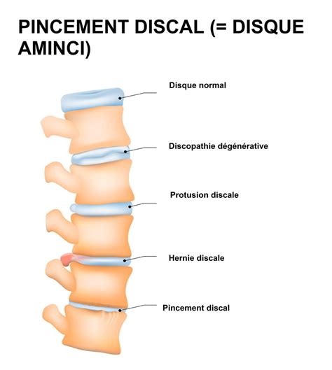 Disc Narrowing Definition Symptoms And Treatment