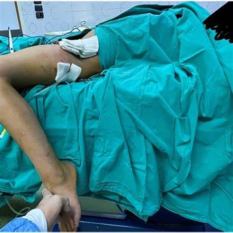 Plain X Ray Shows No Abnormalities But Heterotopic Ossification Download Scientific Diagram