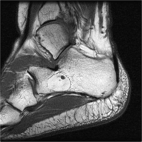 Calcaneal Intraosseous Lipoma Treated With External Fixation A Case Report And Review Of The