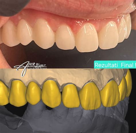 Digitaldentistry Cadcam Exocad Smilemakeover Veneers Exocadexperts Naturalsmile Dr Amr