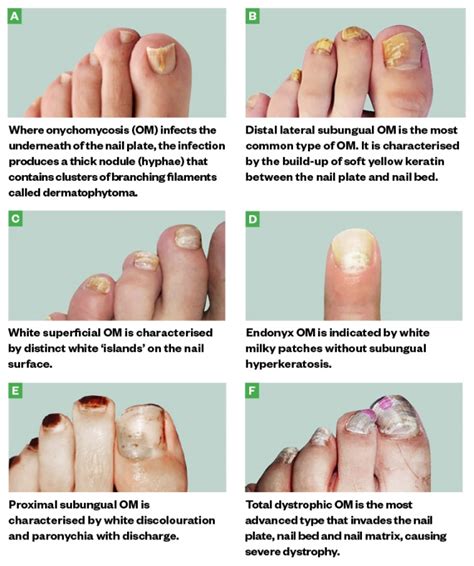 Treatment For Toenails Fungus Philadelphia Holistic Clinic