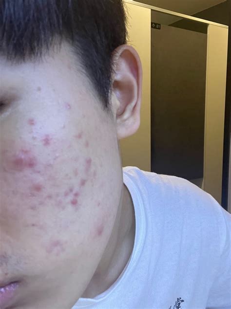 18살 남자 여드름 고민 지식in