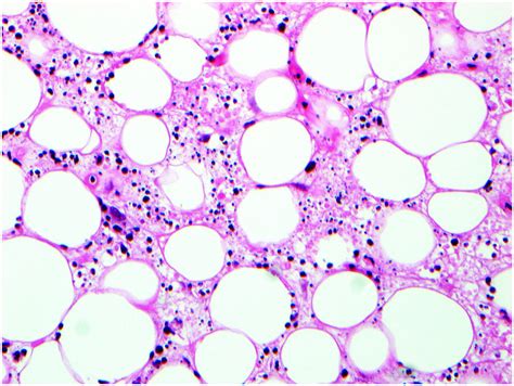 Panniculitis Cellulitis
