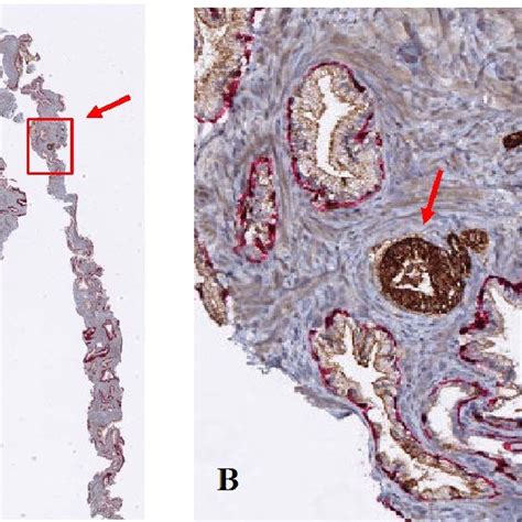A Trans Perineal Template Guided Mapping Biopsy B Freehand Download Scientific Diagram