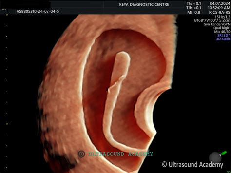 Asherman Syndrome Case By Dr Nitin Jadhav