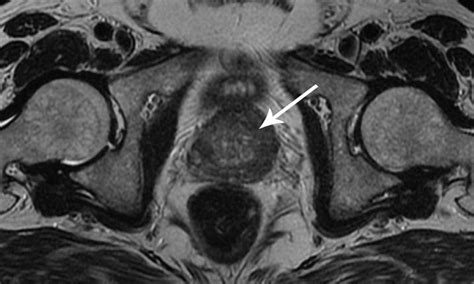 Mri Could Solve Prostate Cancer Overdiagnosis Insight