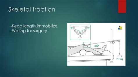 Femoral Shaft Fractures PPT