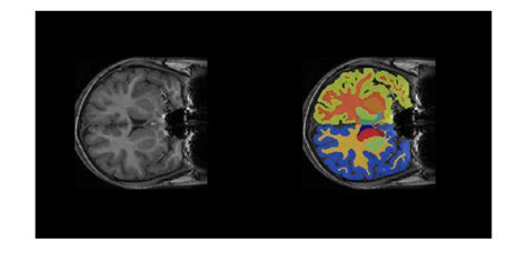 Brain Mri Segmentation Using Pretrained 3 D U Net Network Matlab And Simulink