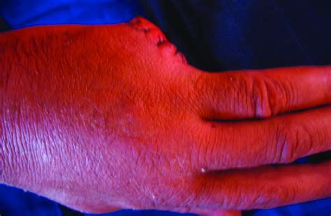 Clinical Image Of The Hand After Revision Amputation Of The Small Download Scientific Diagram