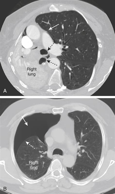 Recognizing The Causes Of An Opacified Hemithorax Clinical Tree