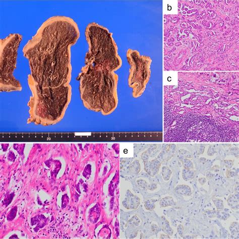 Pathological Findings A Macroscopic View Bc The Tumor And