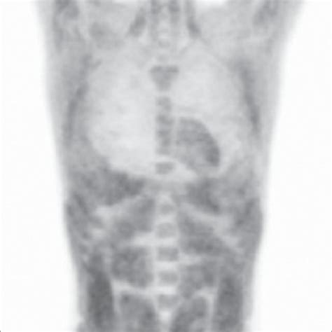 Normal Fdg Distribution Download Scientific Diagram