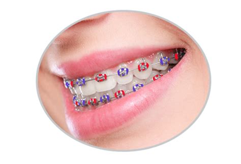 Braces Colors That Look Good Together