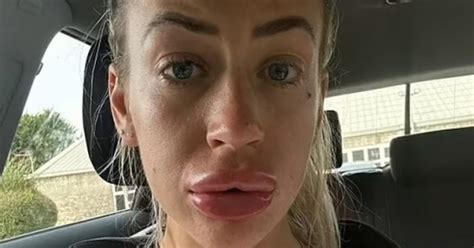 英 20대 여성 입술 풍선처럼 부풀어 알레르기 때문