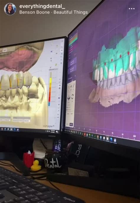 Donia Hazem On Linkedin Cadcam Digitaldentistry Denturedesign Fullarchrestoration